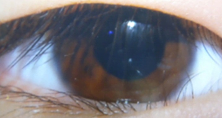 Epiblepharon: Causes & Surgery & Treatment | Eye & Aesthetic Surgeons