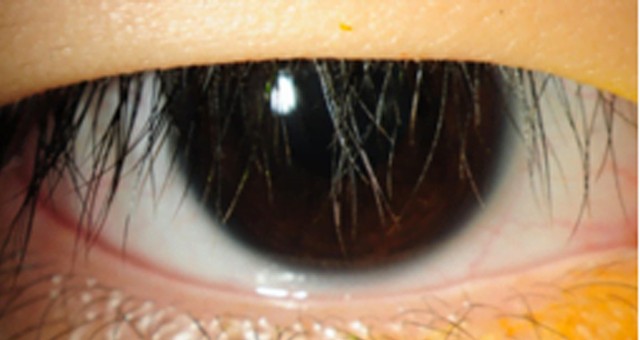 Epiblepharon: Causes & Surgery & Treatment | Eye & Aesthetic Surgeons