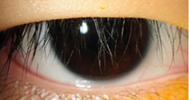 Epiblepharon: Causes & Surgery & Treatment | Eye & Aesthetic Surgeons