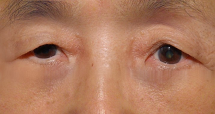 Dermatochalasis: Excess Fat In Eyelids | Blepharoplasty | Eye ...