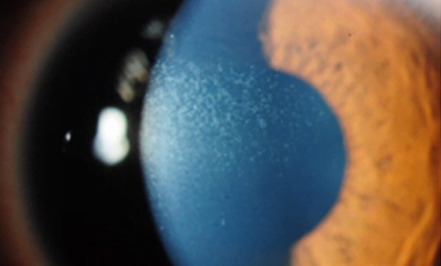 Epiblepharon: Causes & Surgery & Treatment | Eye & Aesthetic Surgeons